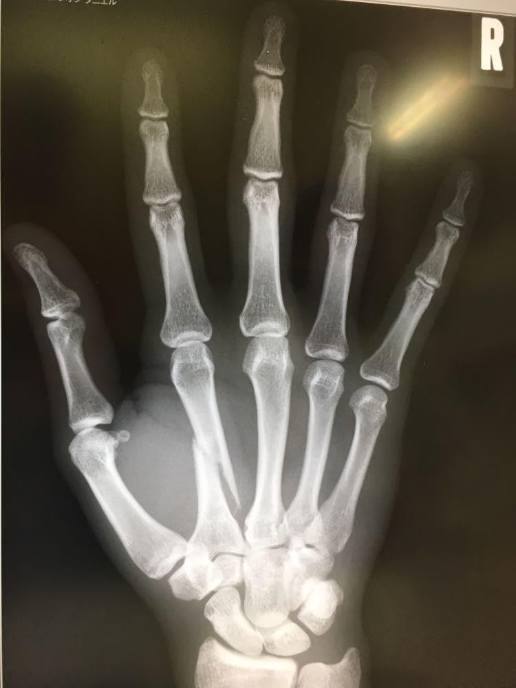 Radiografías De Manos Rotas Archivo:X Ray Of Normal Hand By
